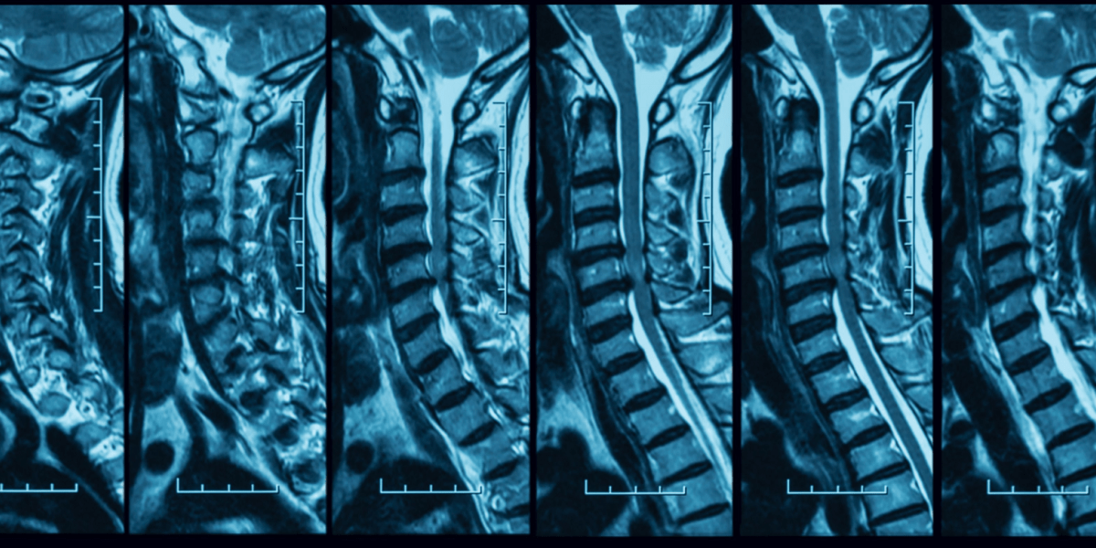 Estenosis cervical: Sobre este problema
