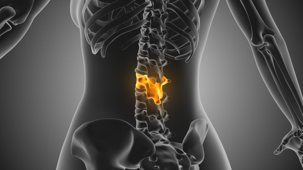 Síndrome facetario lumbar: una aproximación